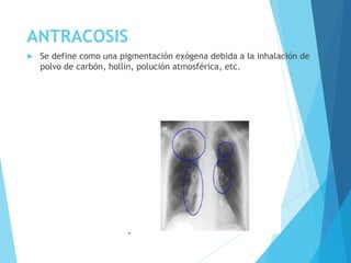 Neumoconiosis en Radiologia | PPTX