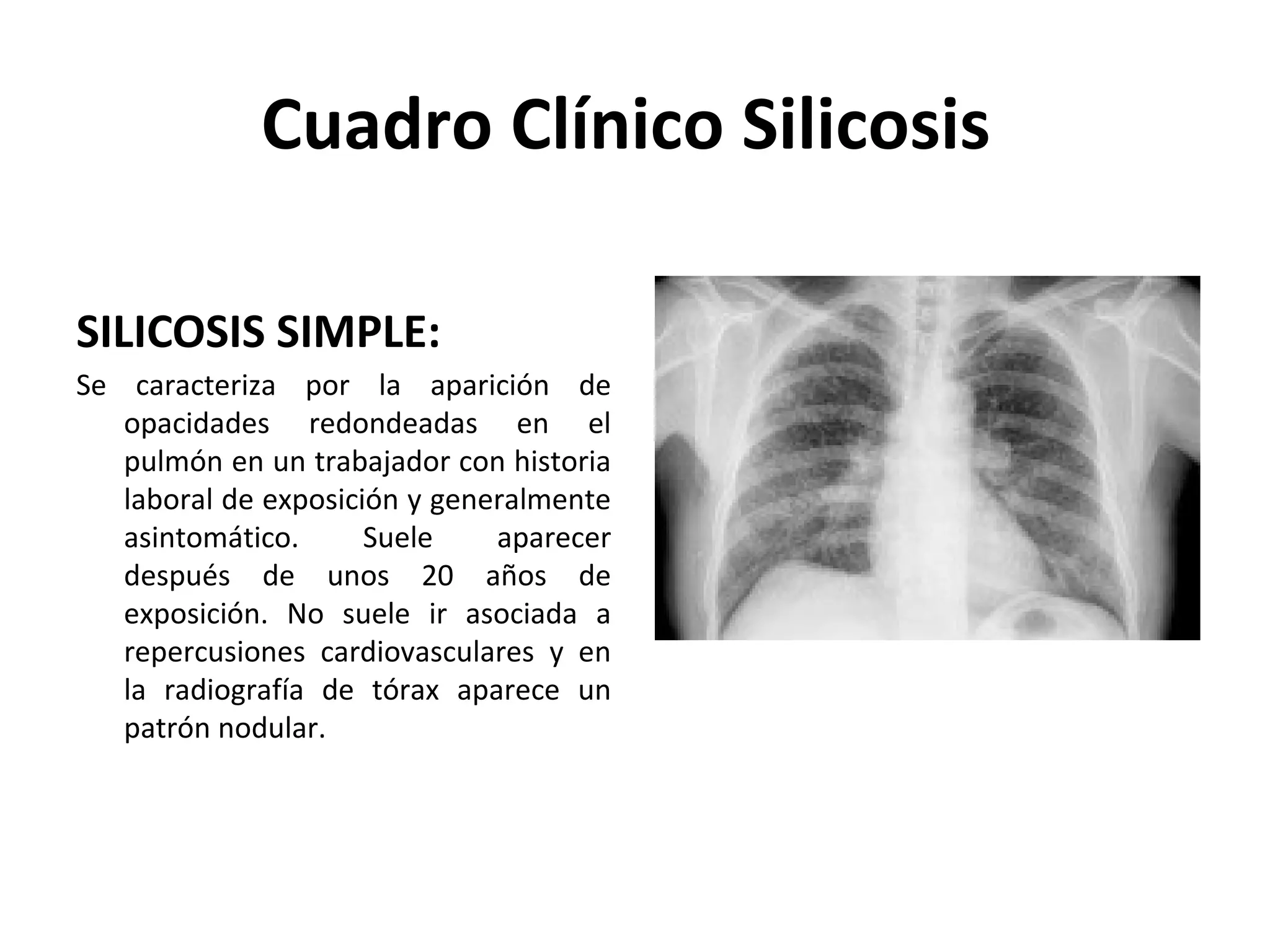 Neumoconiosis | PPT