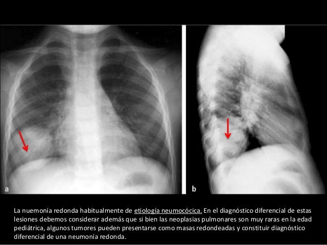 Neumonía - Patrones Radiografías y Características (RX)