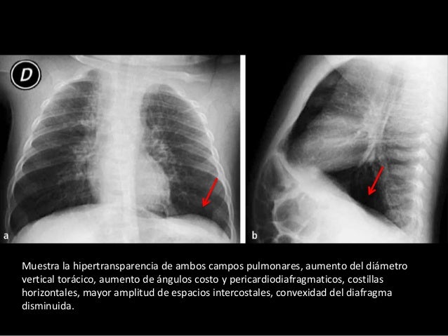 Neumonía - Patrones Radiografías y Características (RX)