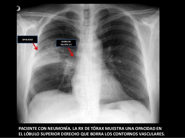 Neumonía - Patrones Radiografías y Características (RX)
