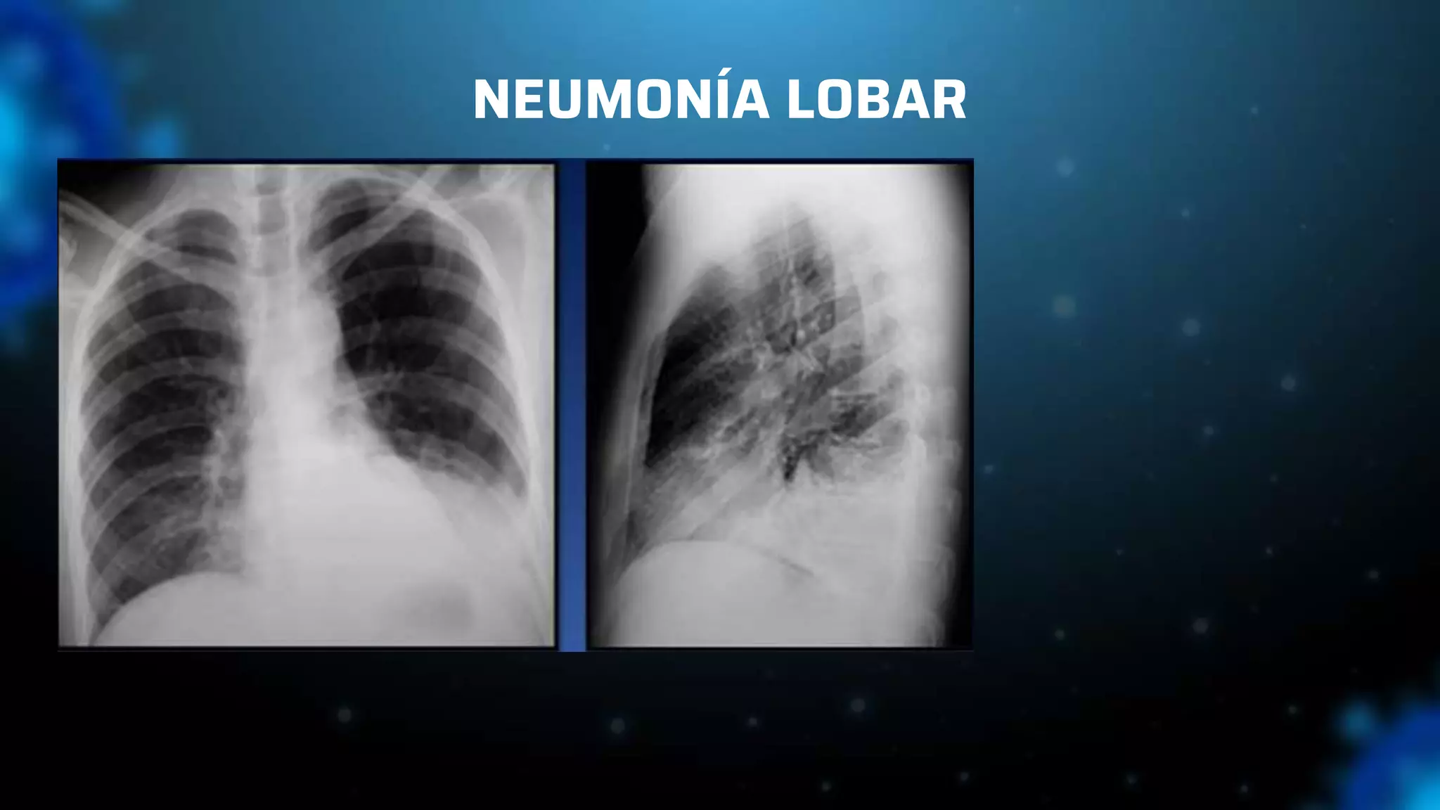 NEUMONÍA PATRÓN ALVEOLAR.pptx