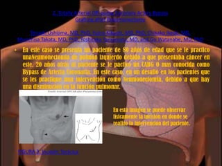 Neumonectomia. Yeison Alexander Millan Montañez semestre I Medicina | PPTX