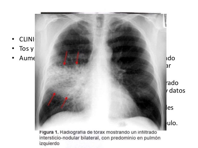 Neumonia