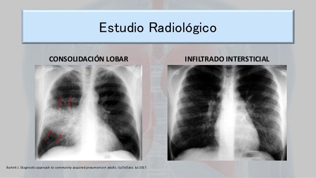 Neumonia