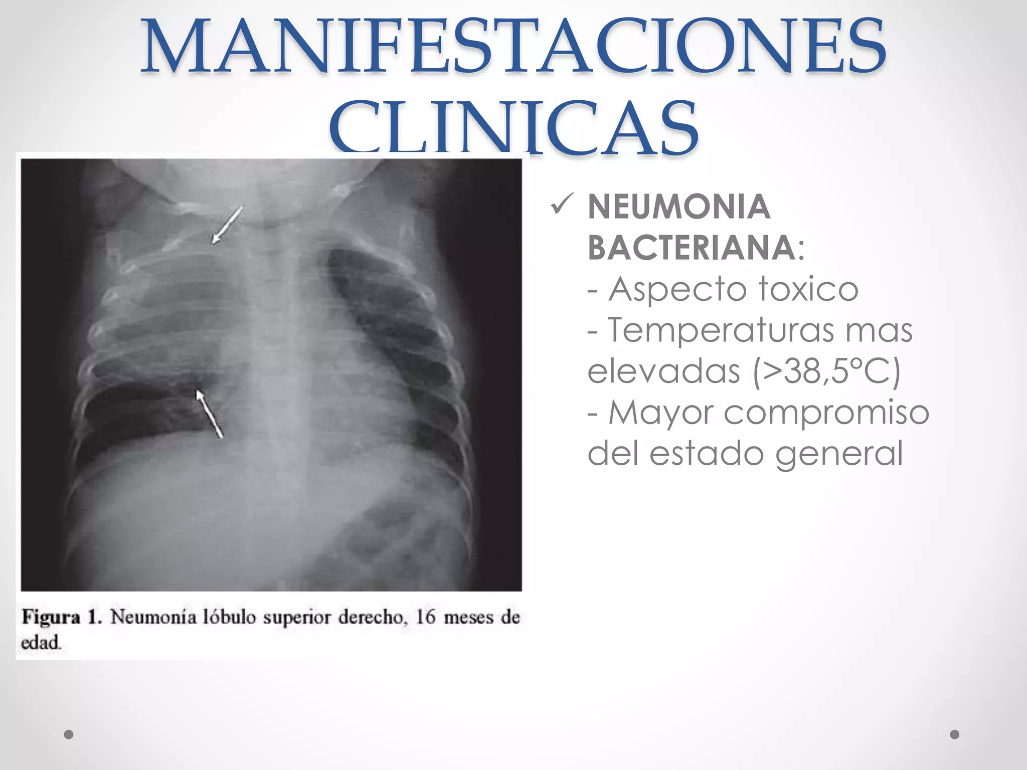 Neumonia adquirida en la comunidad en pediatria | PPTX
