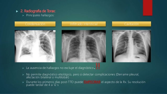 Neumonia adquirida en la comunidad