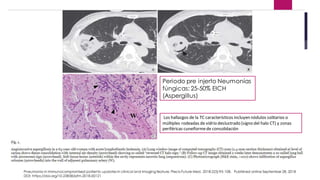Neumonia en inmunocomprometidos | PDF