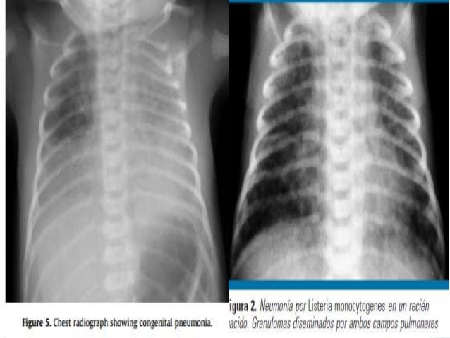 Neumonia neonatal/ Neonatologia / Enfermedades Respiratorias del RN