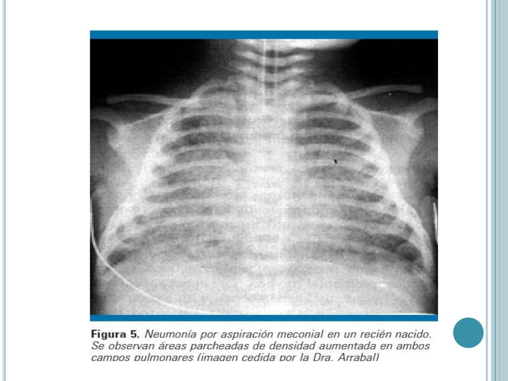 Neumonia neonatal/ Neonatologia / Enfermedades Respiratorias del RN