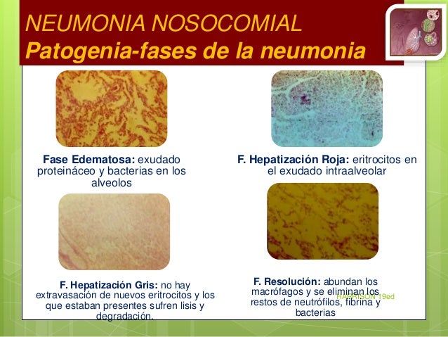 Neumonia nosocomial