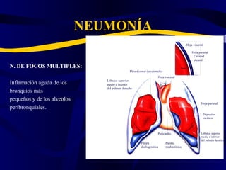 Neumonia pediatria | PPT