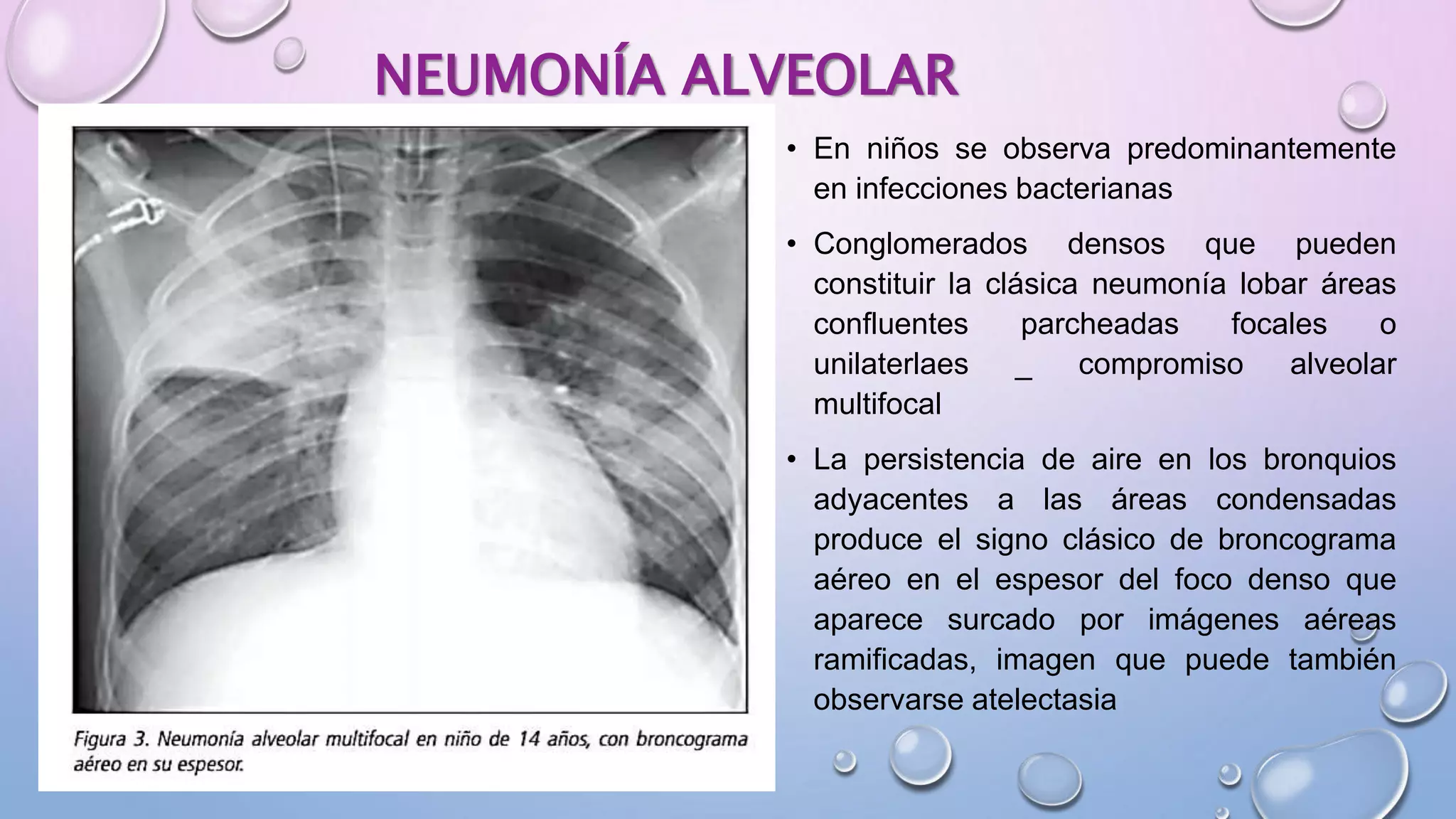 Neumonia ppt | PPT