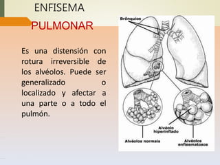 neumoniaprocesodeatenciondeenfermeria-171222054504-2.pdf