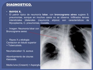 Neumonias en el adulto | PPT