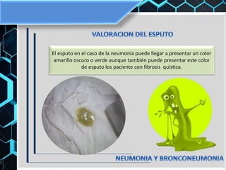 Neumonia y bronconeumonia fg | PDF