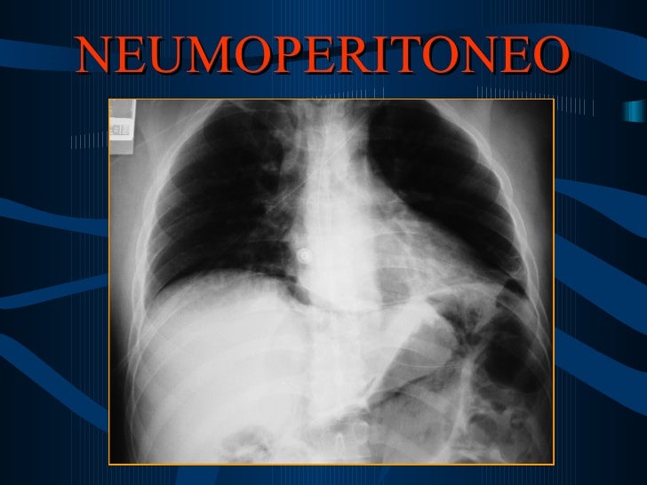 Neumoperitoneo