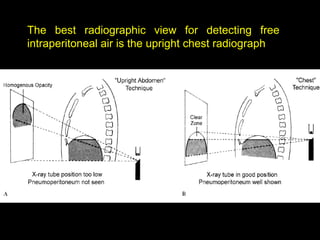 Neumoperitoneo | PPT