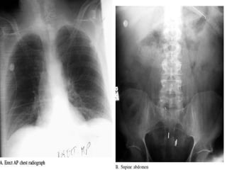 Neumoperitoneo | PPT