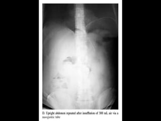 Neumoperitoneo | PPT