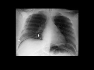 Neumoperitoneo | PPT