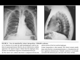 Neumoperitoneo | PPT