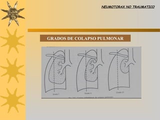 Neumotorax | PPT
