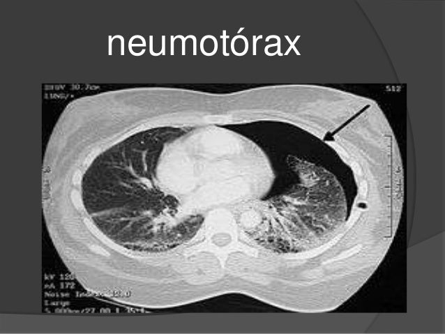 Neumotorax