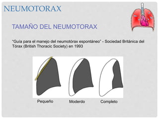 Neumotorax Pptx