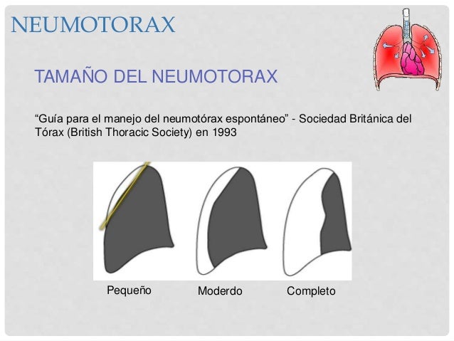 Neumotorax