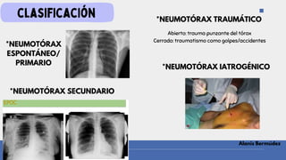 Clase Basica Para Estudiantes De Neumotorax Pdf