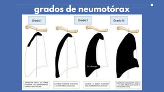 Clase basica para estudiantes de neumotorax.pdf