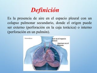 Neumotórax y manejo anestésico, clasificacion | PPTX