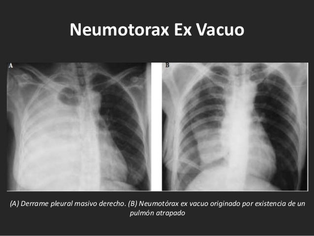 Neumotorax y neumomediastino