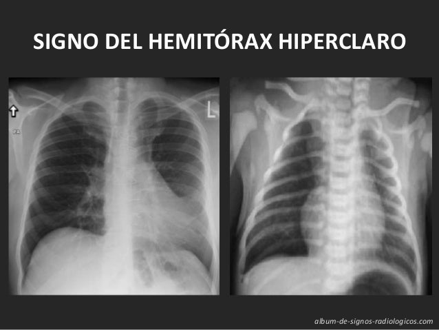 Neumotorax y neumomediastino