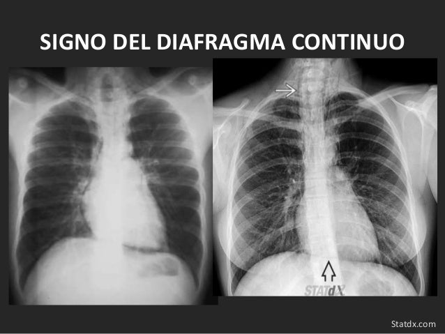 Neumotorax y neumomediastino