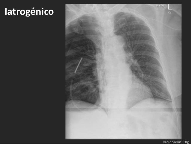 Neumotorax y neumomediastino
