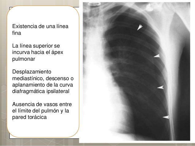 Neumotórax-Imagenología-Radiología