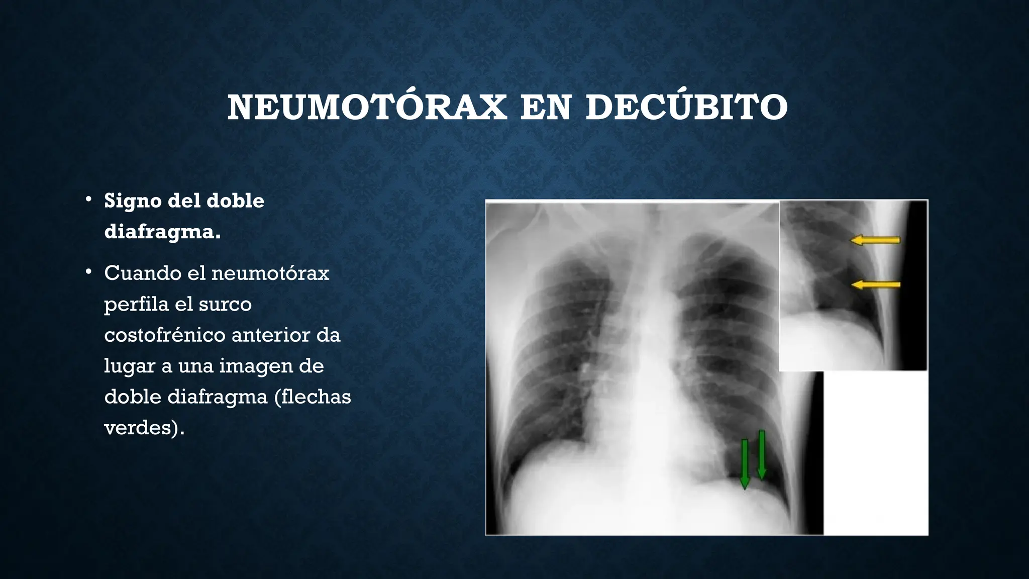 Neumotórax por radiológica y tomografia.pptx