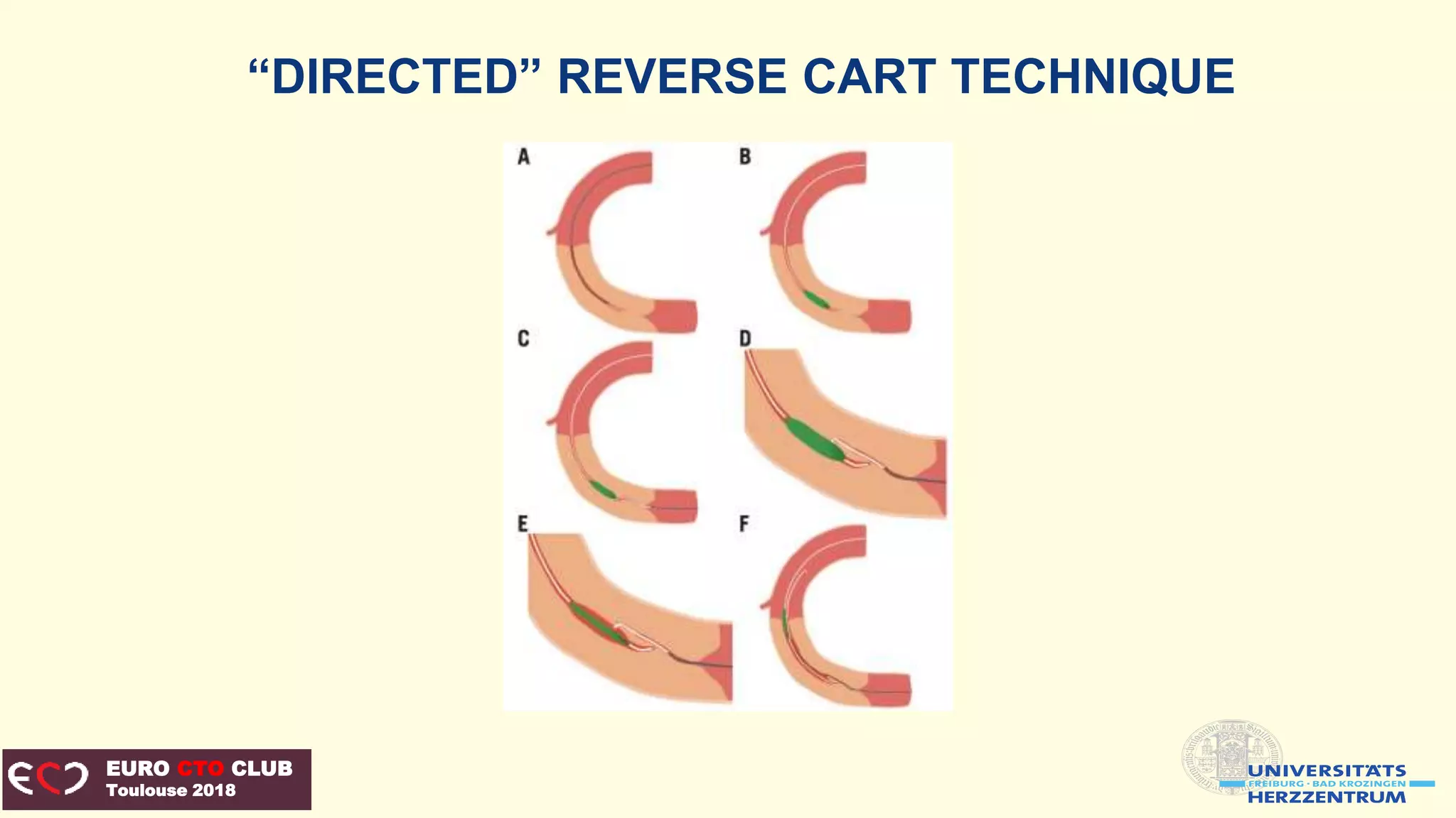 Reverse CART techniques: conventional, directed, extended, assisted … | PPT