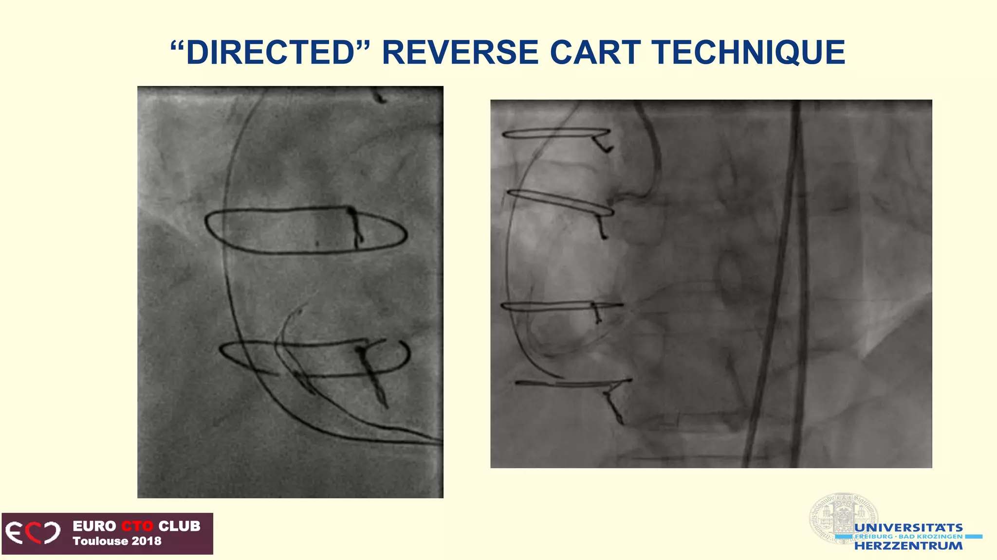 Reverse CART techniques: conventional, directed, extended, assisted … | PPT