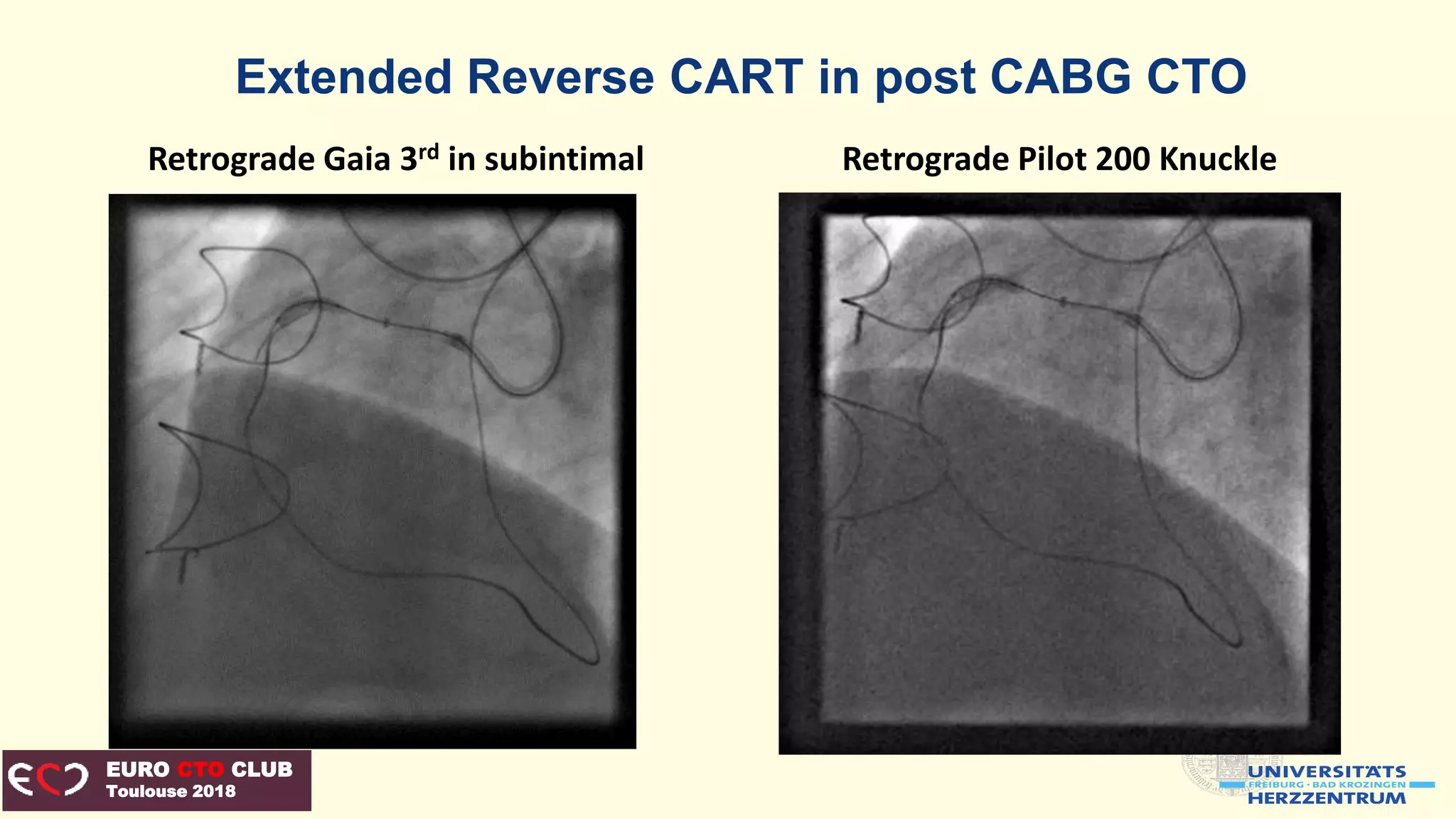 Reverse CART techniques: conventional, directed, extended, assisted … | PPT