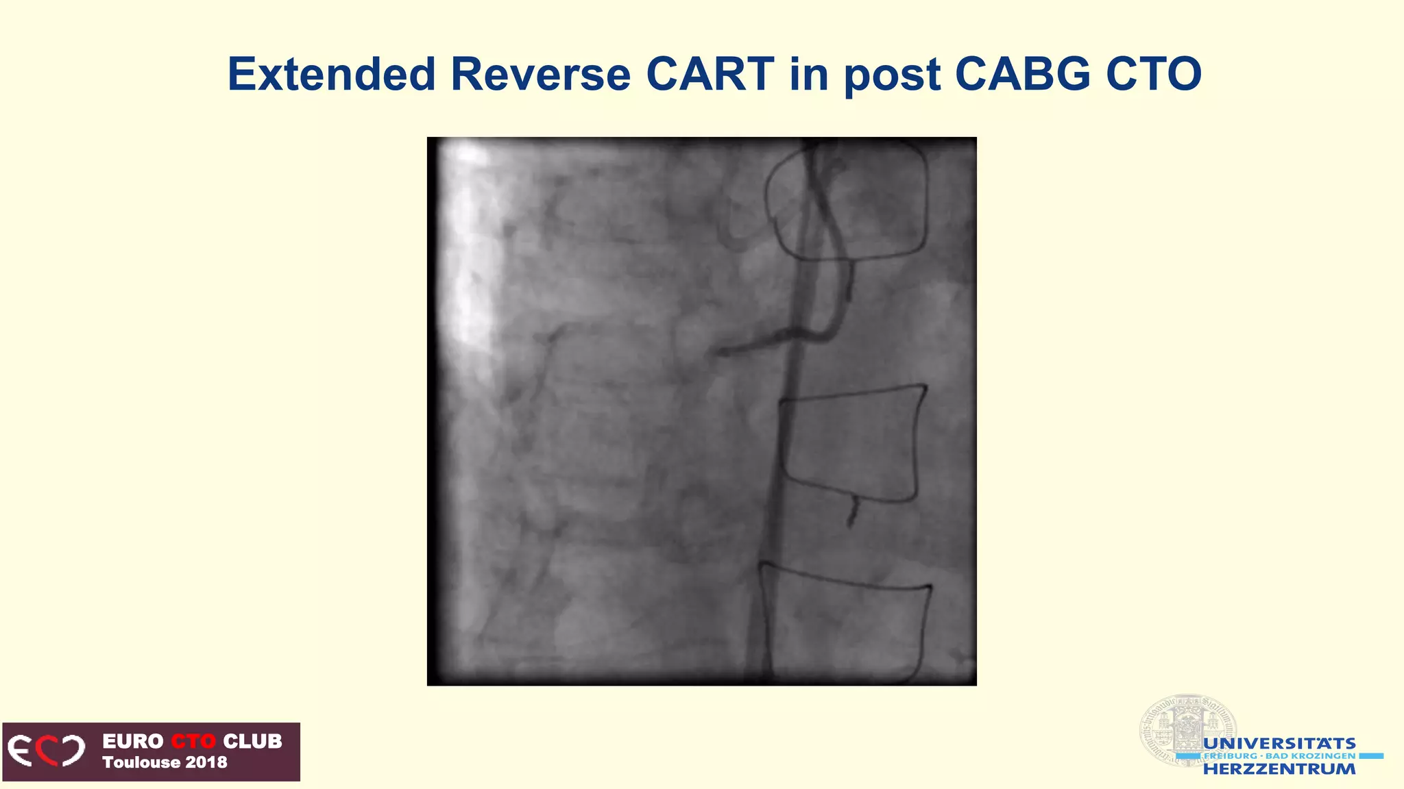 Reverse CART techniques: conventional, directed, extended, assisted … | PPT