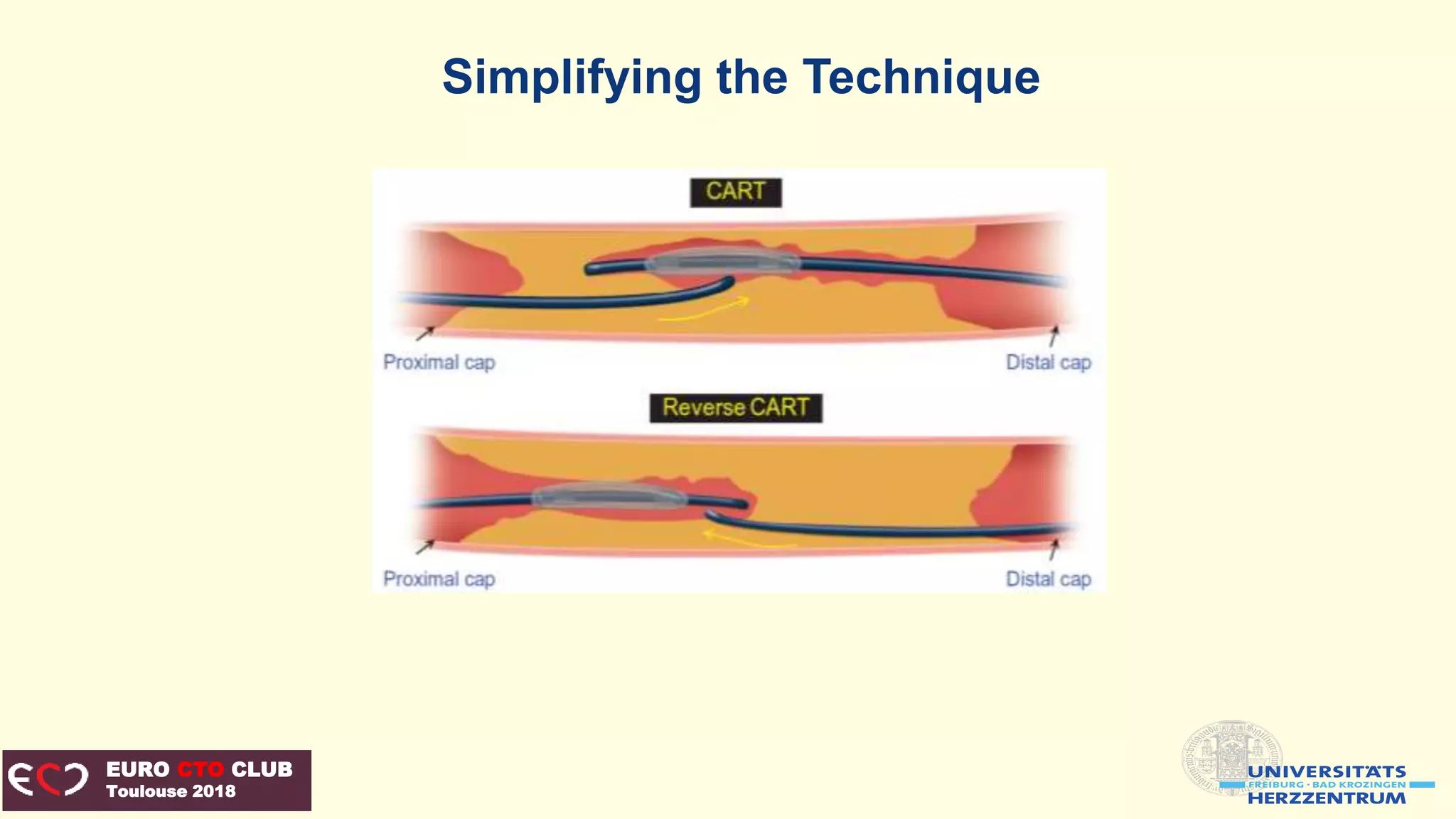 Reverse CART techniques: conventional, directed, extended, assisted … | PPT