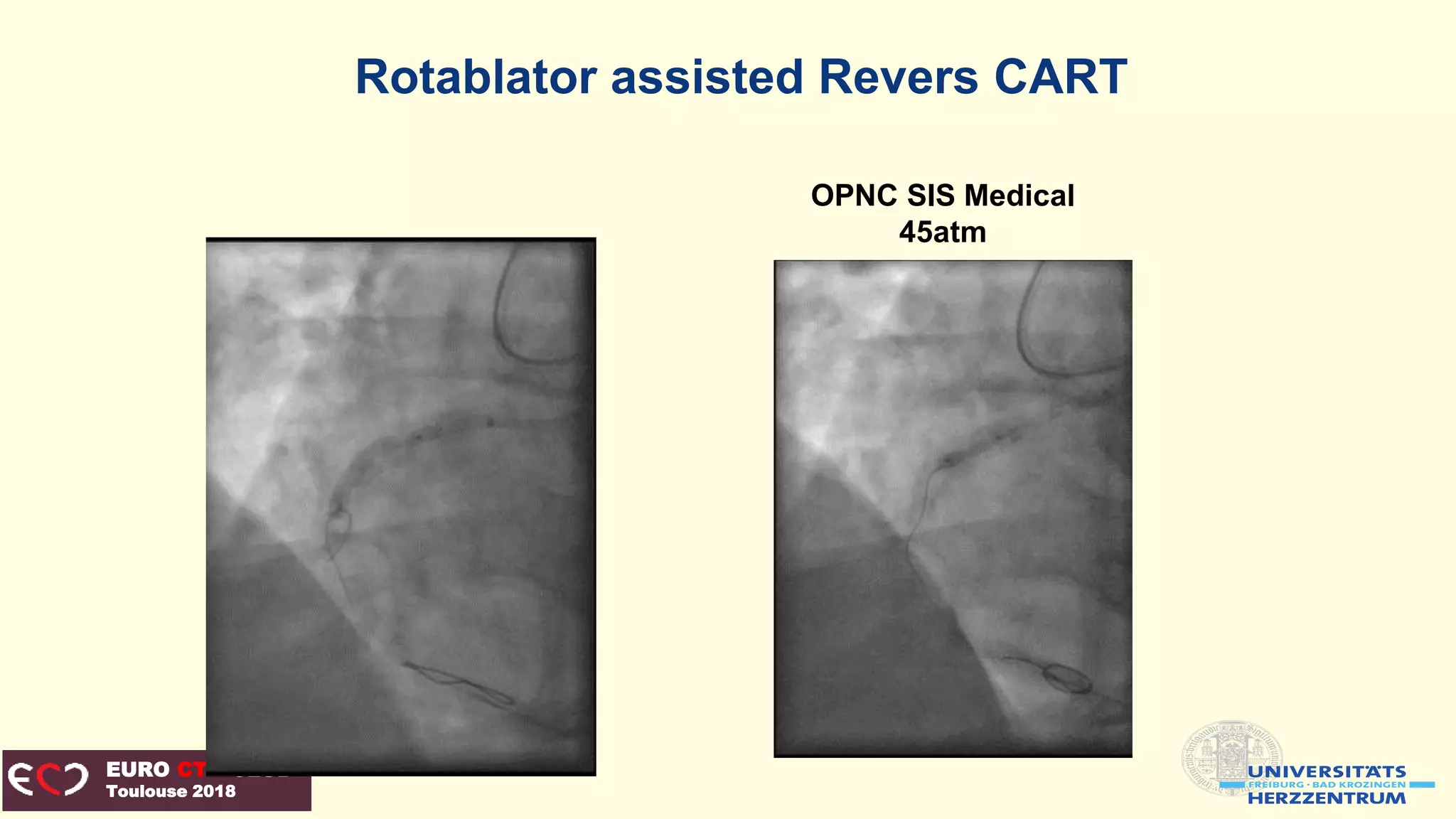 Reverse CART techniques: conventional, directed, extended, assisted … | PPT