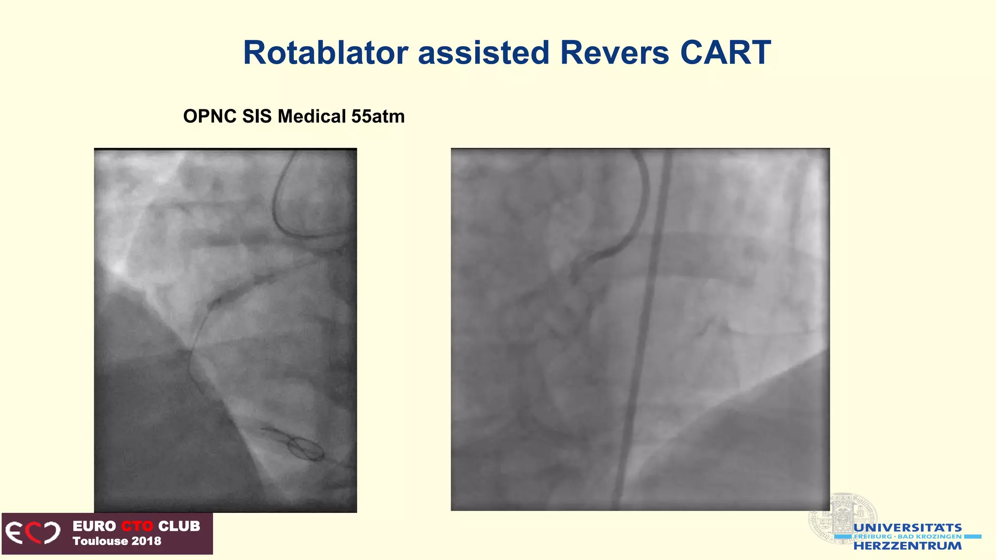 Reverse CART techniques: conventional, directed, extended, assisted … | PPT