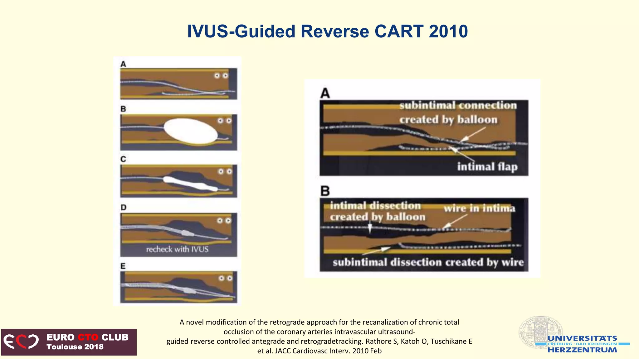Reverse CART techniques: conventional, directed, extended, assisted … | PPT