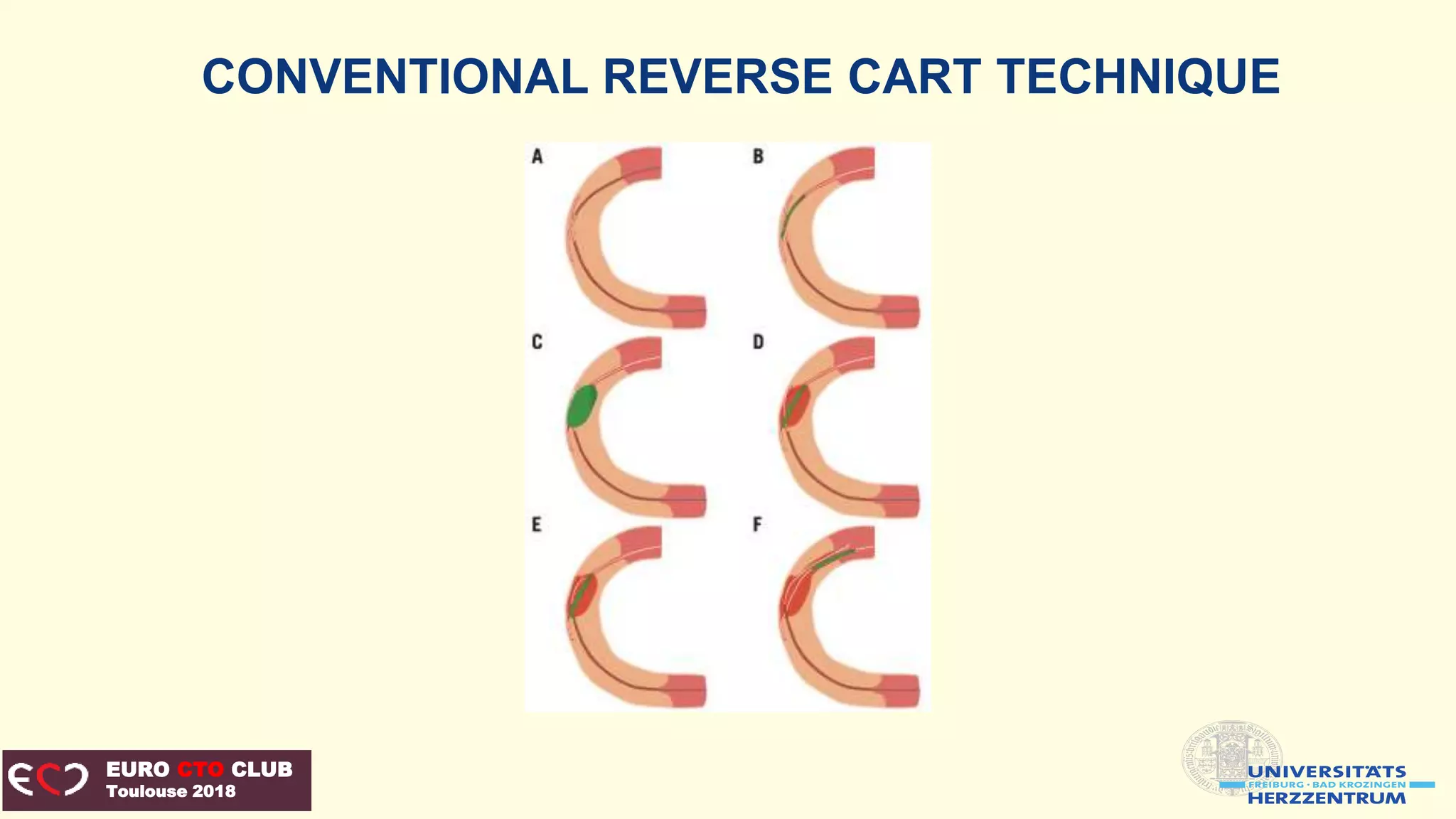 Reverse CART techniques: conventional, directed, extended, assisted … | PPT