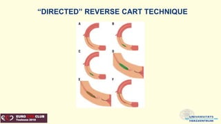 Reverse CART techniques: conventional, directed, extended, assisted … | PPT