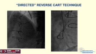 Reverse CART techniques: conventional, directed, extended, assisted … | PPT